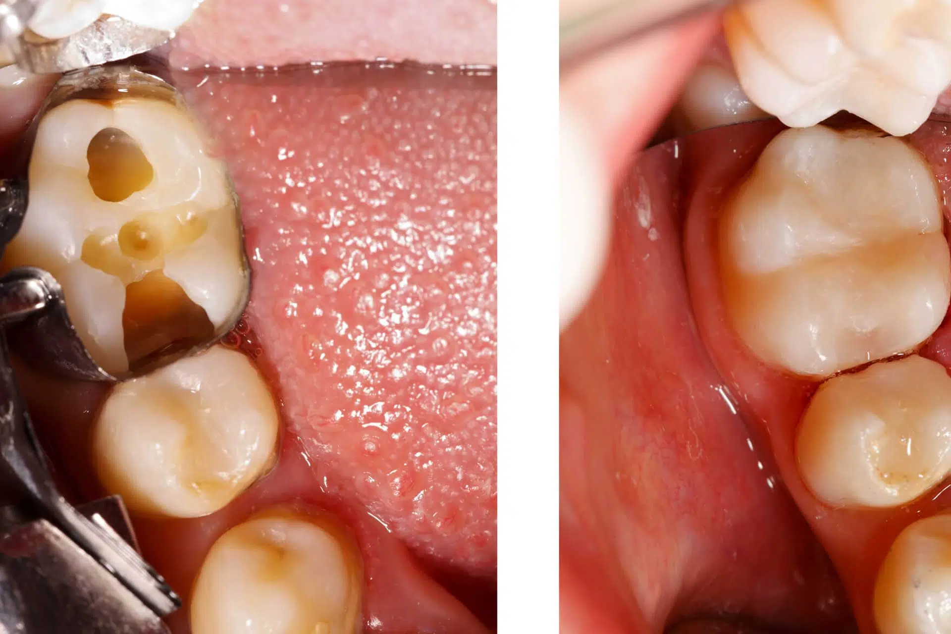 Handling a Lost Filling: Is It a Dental Emergency?